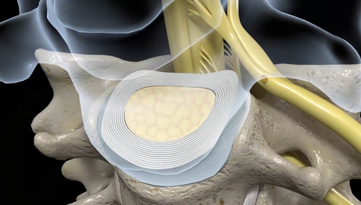 C2-C3 Disc Bulge - Right Side - White Female - 4k - 200908