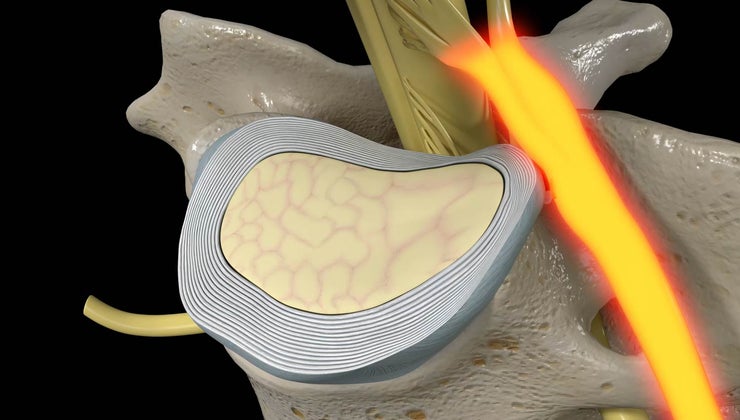 C6-C7 Disc Bulge - Rigth Side - Black Female - 4k - 200968