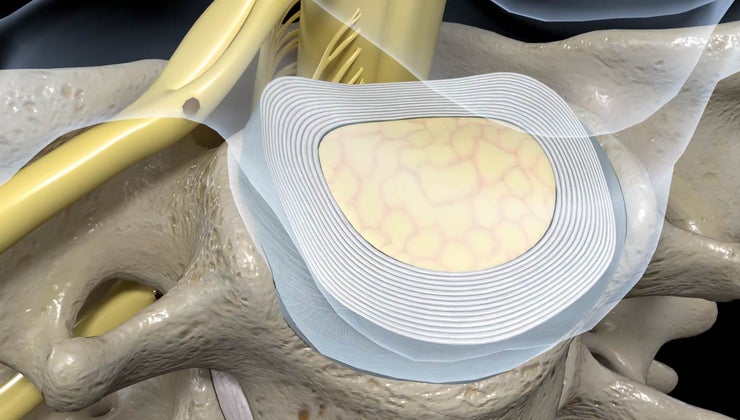 C2-C3 Disc Herniation - Left Side - Black Female - 4k - 201232