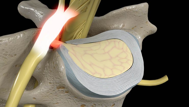 C6-C7 Disc Herniation - Left Side - Black Female - 4k - 201296