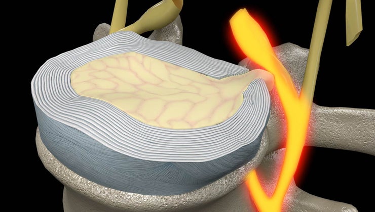 L2-L3 Disc Herniation - Right Side - Hispanic Female - 4k - 201354