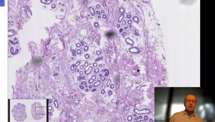 Unusual Form Of Non-Scarring Alopecia With Follicular Miniaturization