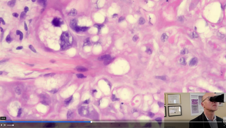 Squamous Cell Carcinoma With Sebaceous Differentiation | Dermpedia