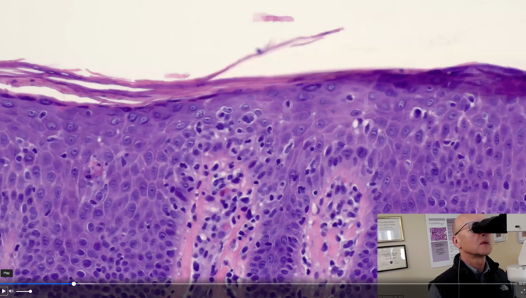 Pityriasis Rubra Pilaris Like Lymphoid Dyscrasia Pre Sezary Syndrome ...