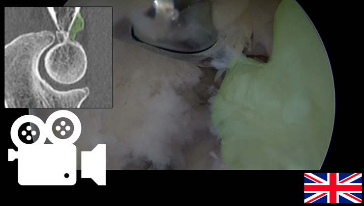 Posterior elbow impingement pain: arthroscopic osteophyte