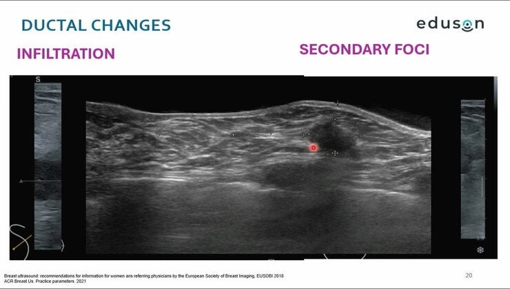 The Updated Birads Lexicon - Prof. Dr. Dana Stoian