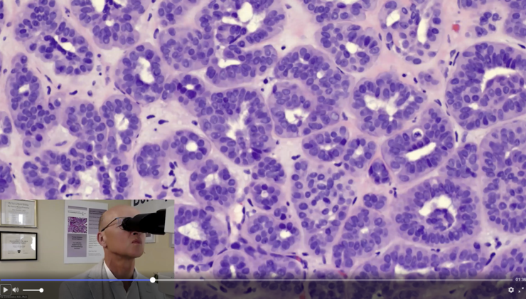 Adnexal Neoplasm With Tubular Architecture