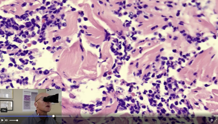 Can You Distinguish Cellulitis From Pyoderma Gangrenosum | Dermpedia