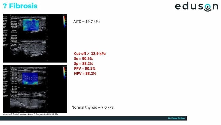 Multiparametric in diffuse thyroid pathology - Prof. Dr. Dana Stoian