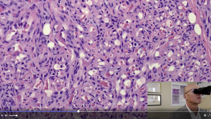 Vascular Tumor With Fat Or Fatty Tumor With Blood Vessels | Dermpedia