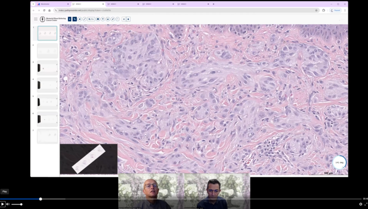 Spitzoid Melanocytic Neoplasm | Dermpedia