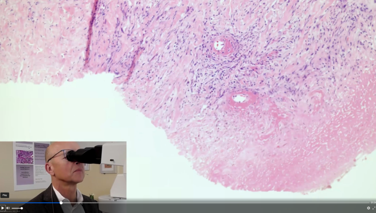 Ulcer Associated With Hyalinizing Vasculopathy Hydroxyurea-Induced ...