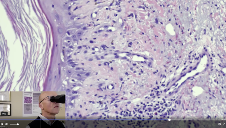 Erythema Multiforme Like Rash | Dermpedia