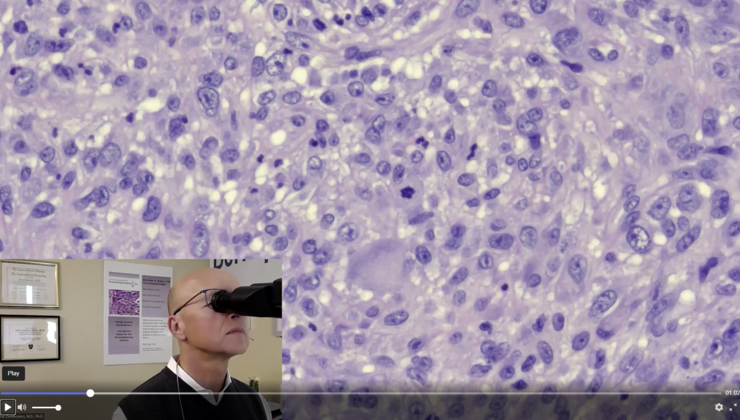 Scc With Poorly Differentiated And Giant Cell Component | Dermpedia