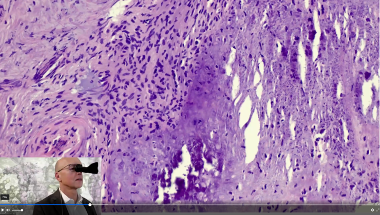 Chondroid Neoplasm Defined By Fn1 Fusion | Dermpedia