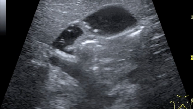 Ultrasonografia clinica a etajului abdominal superior. Ficat. Colecist ...