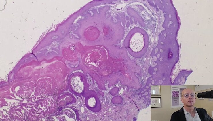 Atypical Endophytic Squamous Proliferation | Dermpedia