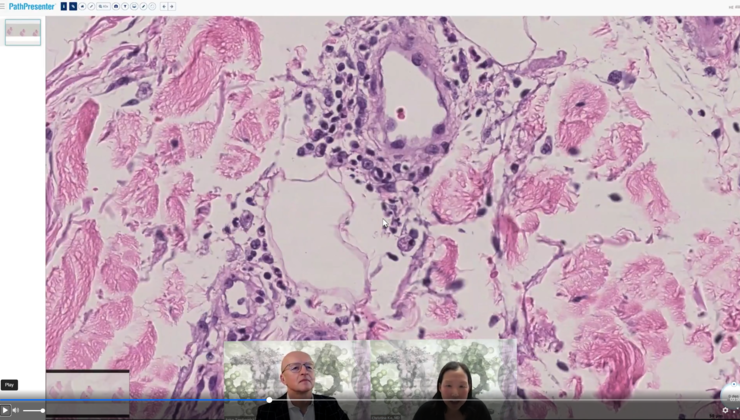 Myelodysplastic Syndrome With Skin Rash And Foamy Histiocytes