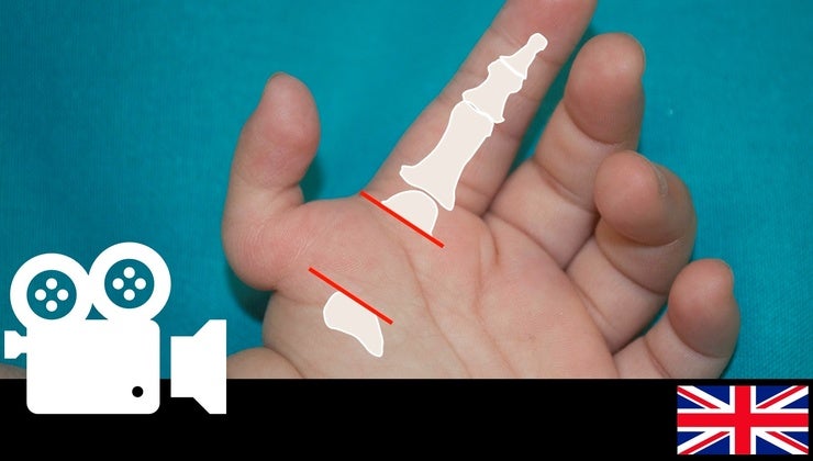 Floating thumb: Index pollicization surgery