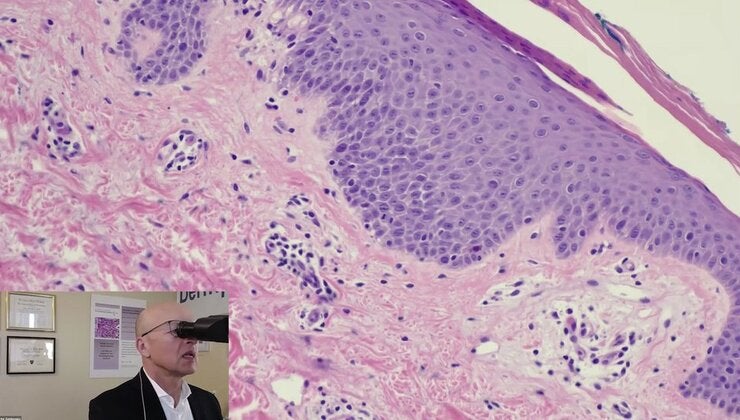 Pityriasiform Dermatitis | Dermpedia