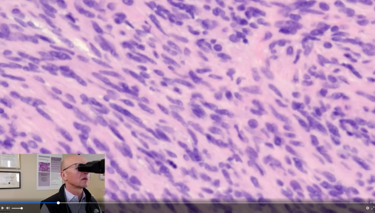 Cellular Spindle Cell Neoplasm Often Challenging For Dermatopathologists