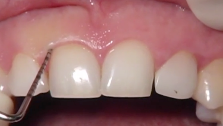 CLINICAL VIDEO Periodontal Crown Lengthening of 10 Maxillary Front ...