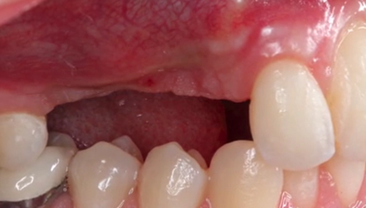 CLINICAL VIDEO Vertical and Horizontal GBR in the Anterior Maxilla ...