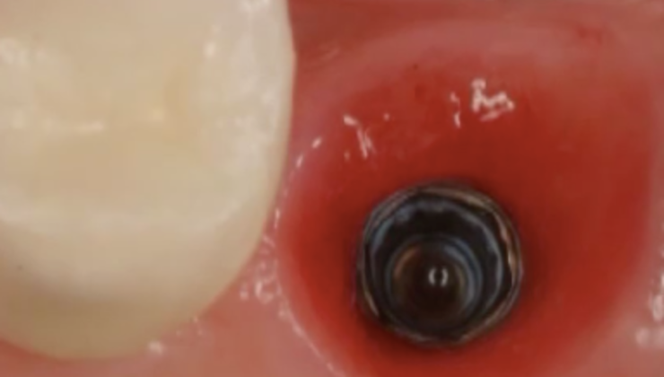 CLINICAL VIDEO Immediate Single-Implant Placement and Loading After ...