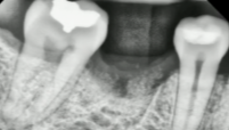 CLINICAL VIDEO Socket Preservation after a Lower Molar Extraction using ...