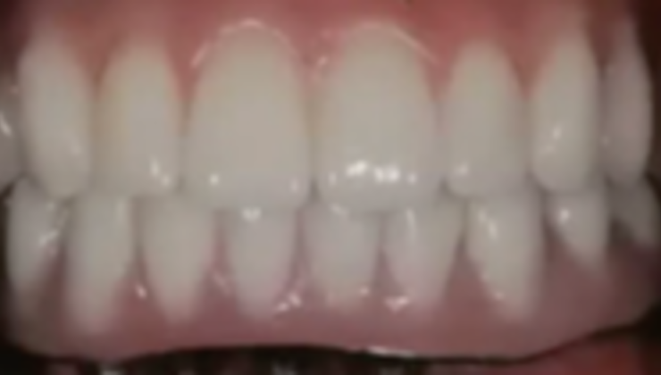 The Edentulous Jaw Restoration: An evaluation of different restorative ...
