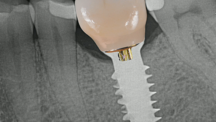 Replacing a Mandibular First Molar Using a Tissue Level Implant | Dr ...