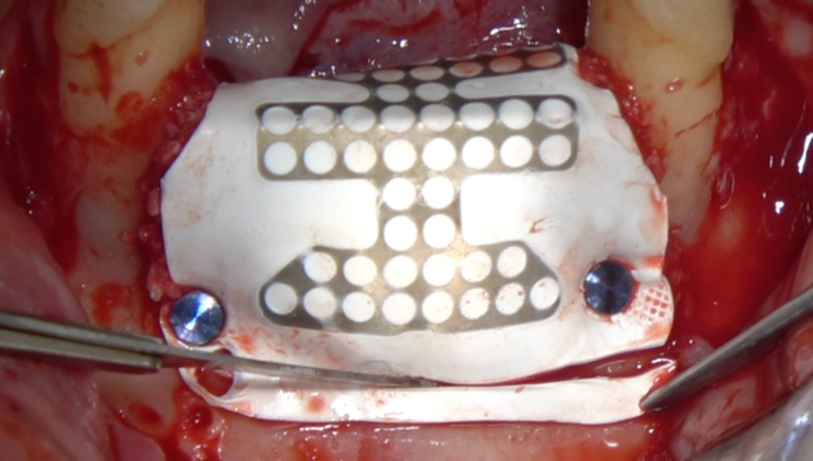 CLINICAL VIDEO Vertical & Horizontal GBR Ridge Augmentation of a Severe ...