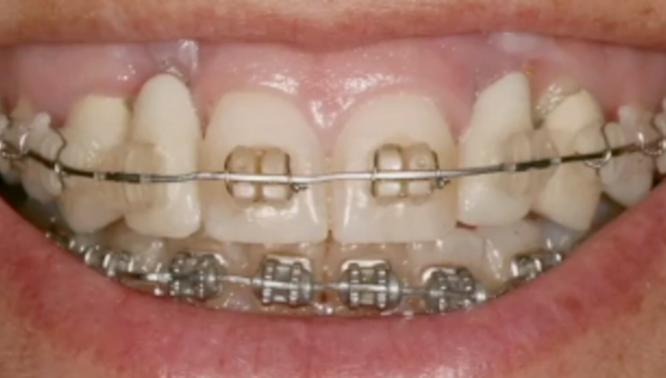 Esthetic Implant Failures - Etiologies and Solutions | Dr Bobby Butler ...