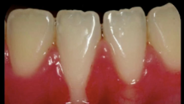 Severe Gingival Recession Treatment with Connective Tissue Grafts | Dr ...