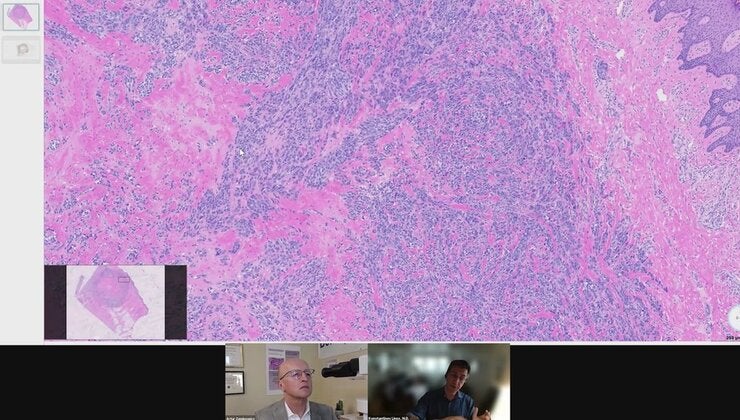 Metastatic Pleomorphic Epithelioid Cell Tumor With Sox10 And S100 ...