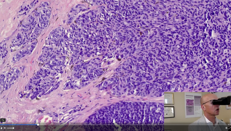 Excercise In Assessing Probability Of A Lesion Being A Melanoma | Dermpedia