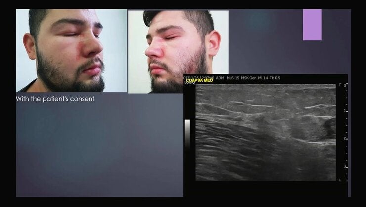 Scoala De Vara Sesiunea Ultrasonografia Musculoscheletală Miozita ...