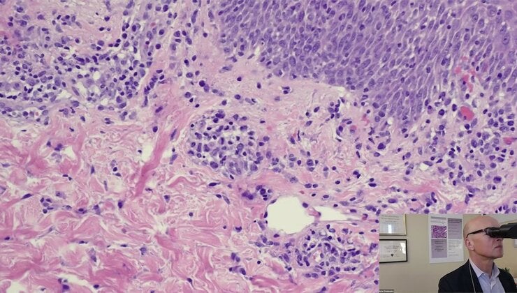 Pityriasiform And Spongiotic Dermatitis | Dermpedia