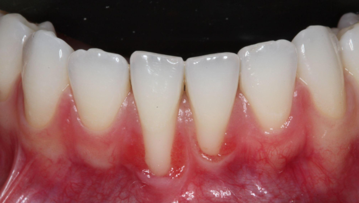 UNCUT! Severe Lower Gingival Recessions Treated with a Custom Gingival ...