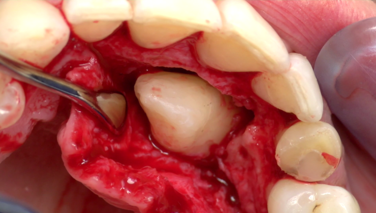CLINICAL VIDEO Canine Auto-Transplantation. What are the steps and the ...