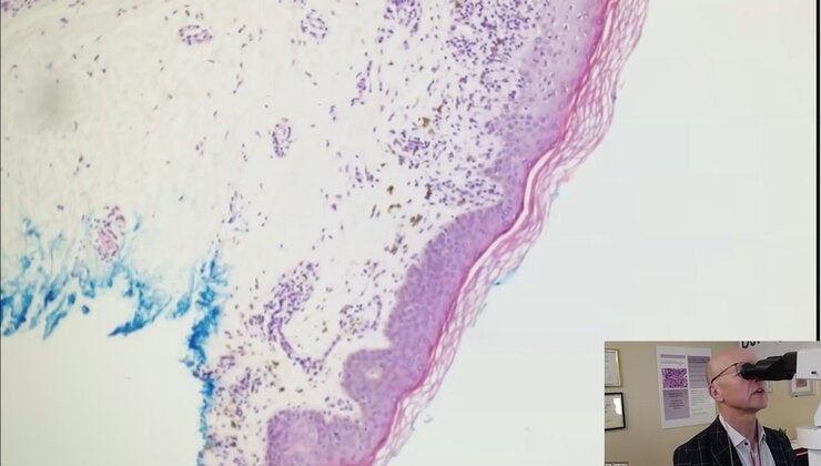 Linear Rash With Lichenoid Interface Dermatitis On The Biopsy