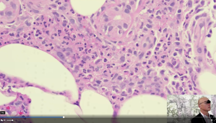 Neutrophilic Dermatosis In A Patient With Ulcerative Colitis