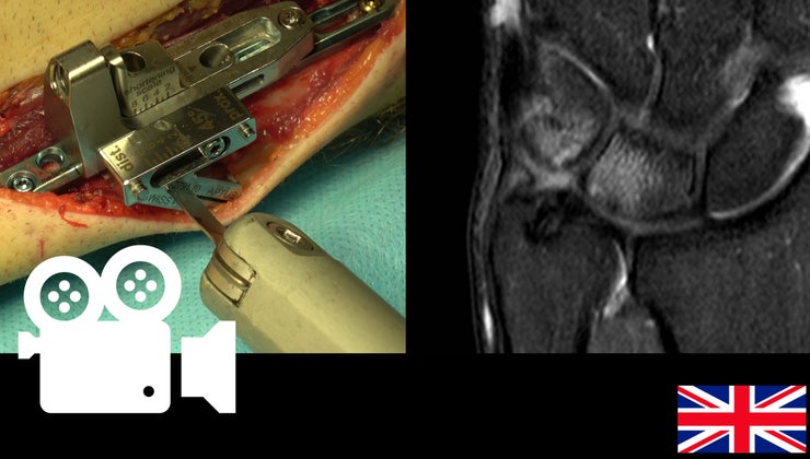 Ulnocarpal impingement: ulnar shortening osteotomy