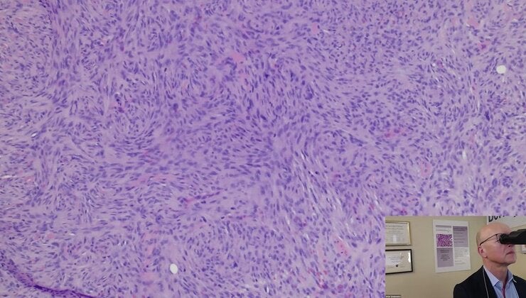 Spindle Cell Mesenchymal Neoplasm With Tumor Necrosis