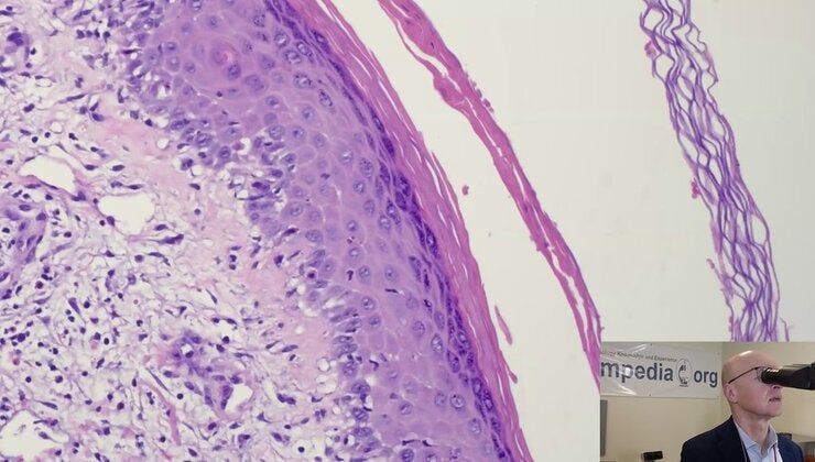 Fixed Drug Eruption With Eosinophils