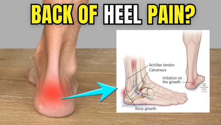 Back of Heel Pain Explained: Haglund’s Deformity, Retrocalcaneal ...