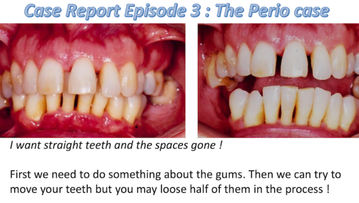 Unconventional Cases Episode 3: The Perio Case Trailer | AlignerMaster ...