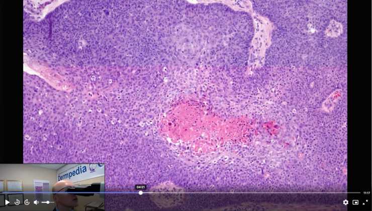 Basaloid Squamous Cell Carcinoma Of the Skin