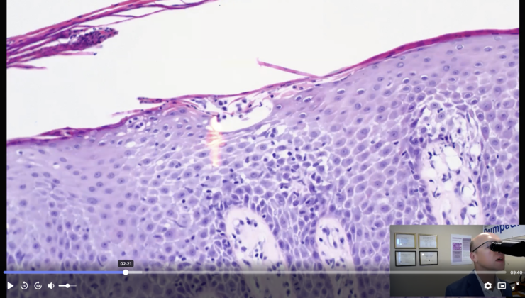 Psoriasiform reaction to a biologic | Dermpedia