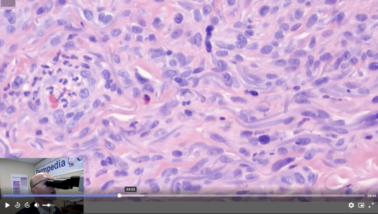 Traumatized banal-looking nevus: Would you use PRAME?